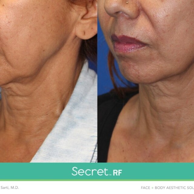 Secret RF Microneedling Procedure | C.D. Bakala MD Inc.
